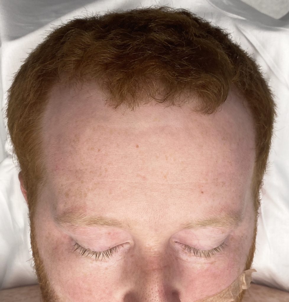 Plastic Surgery Case Study - Forehead and Temporal Skull Reductions for ...