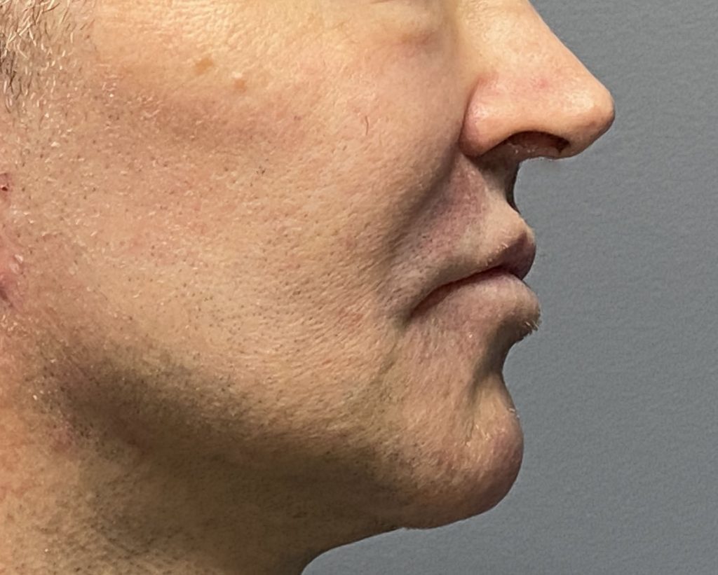Plastic Surgery Case Study - ePTFE Paranasal Implants for Male Nasal ...