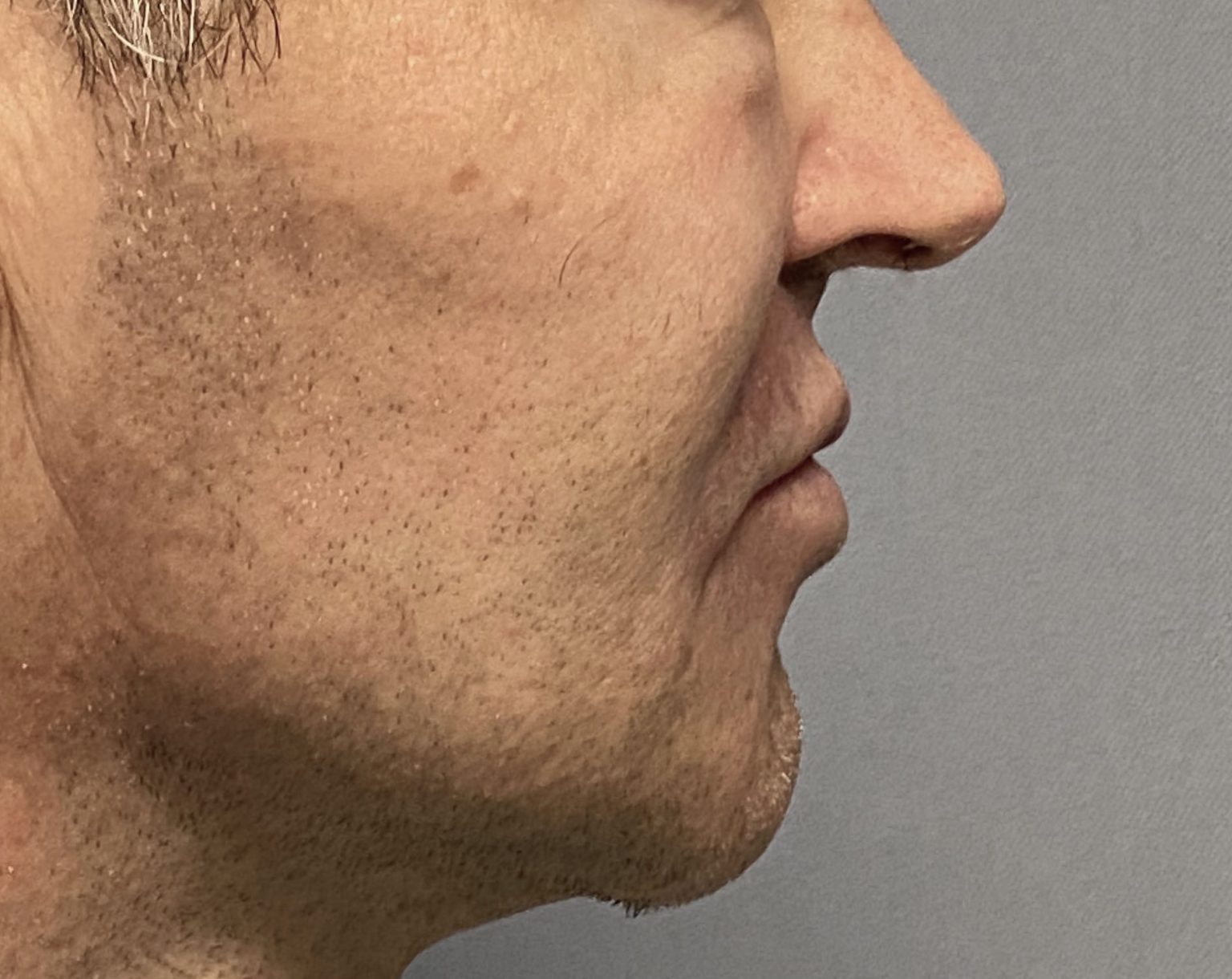 Plastic Surgery Case Study - ePTFE Paranasal Implants for Male Nasal ...