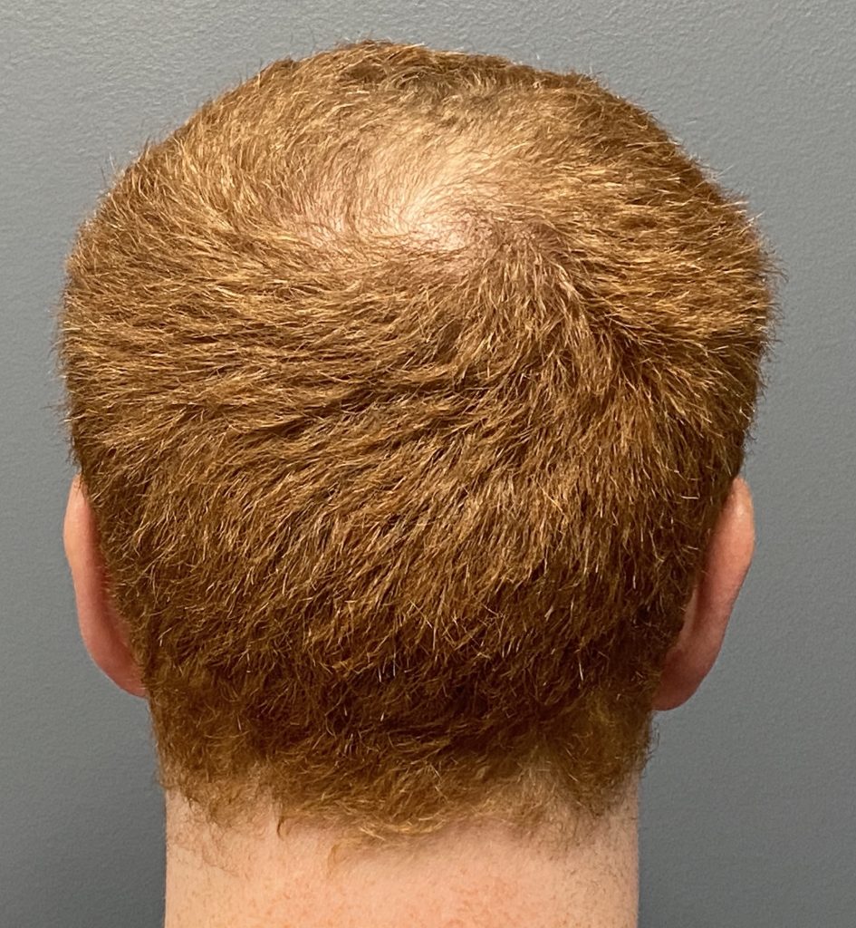 Plastic Surgery Case Study - Forehead and Temporal Skull Reductions for ...