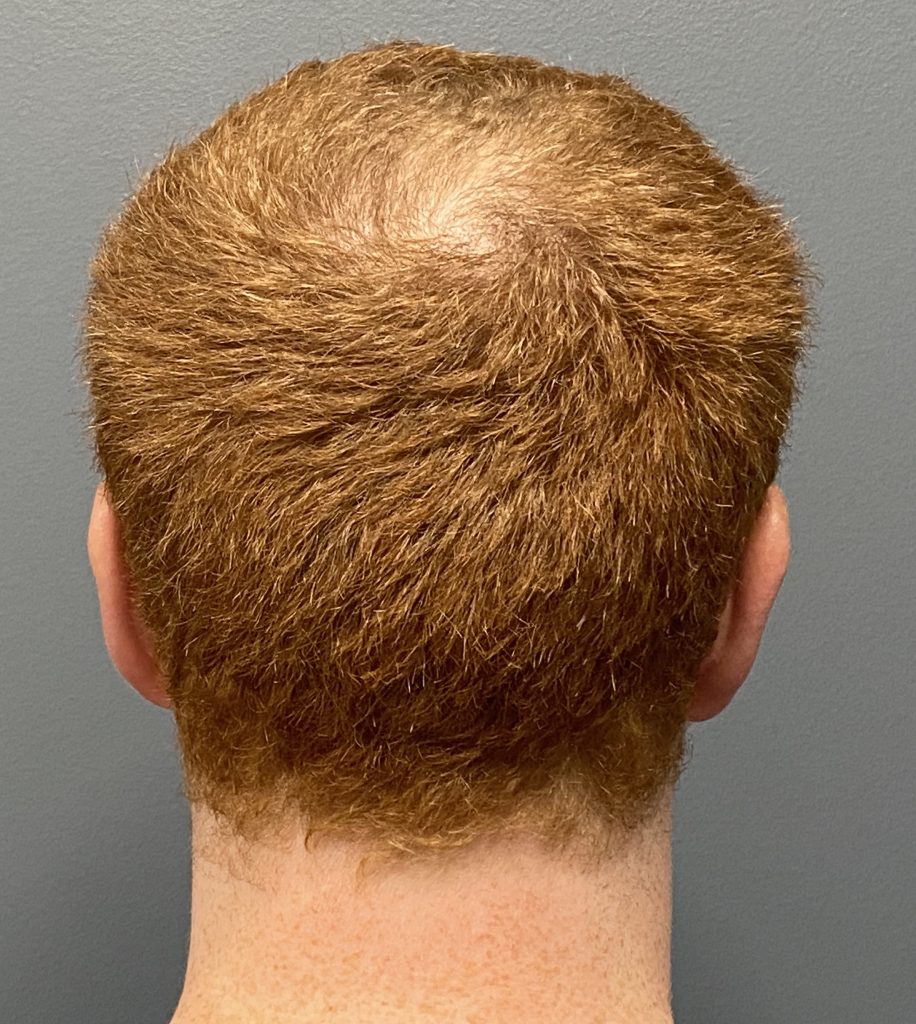 male skull reduction back 1 Dr Barry Eppley - Explore Plastic Surgery