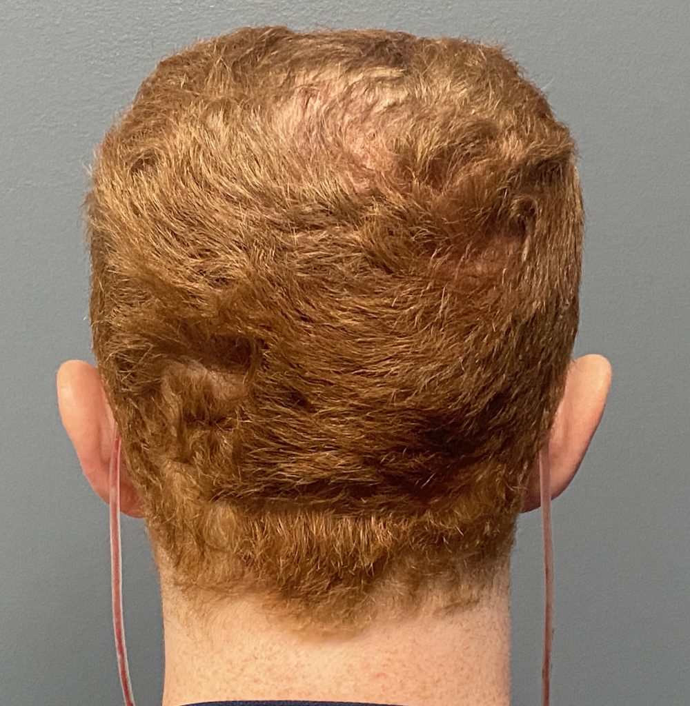 Plastic Surgery Case Study - Forehead and Temporal Skull Reductions for ...