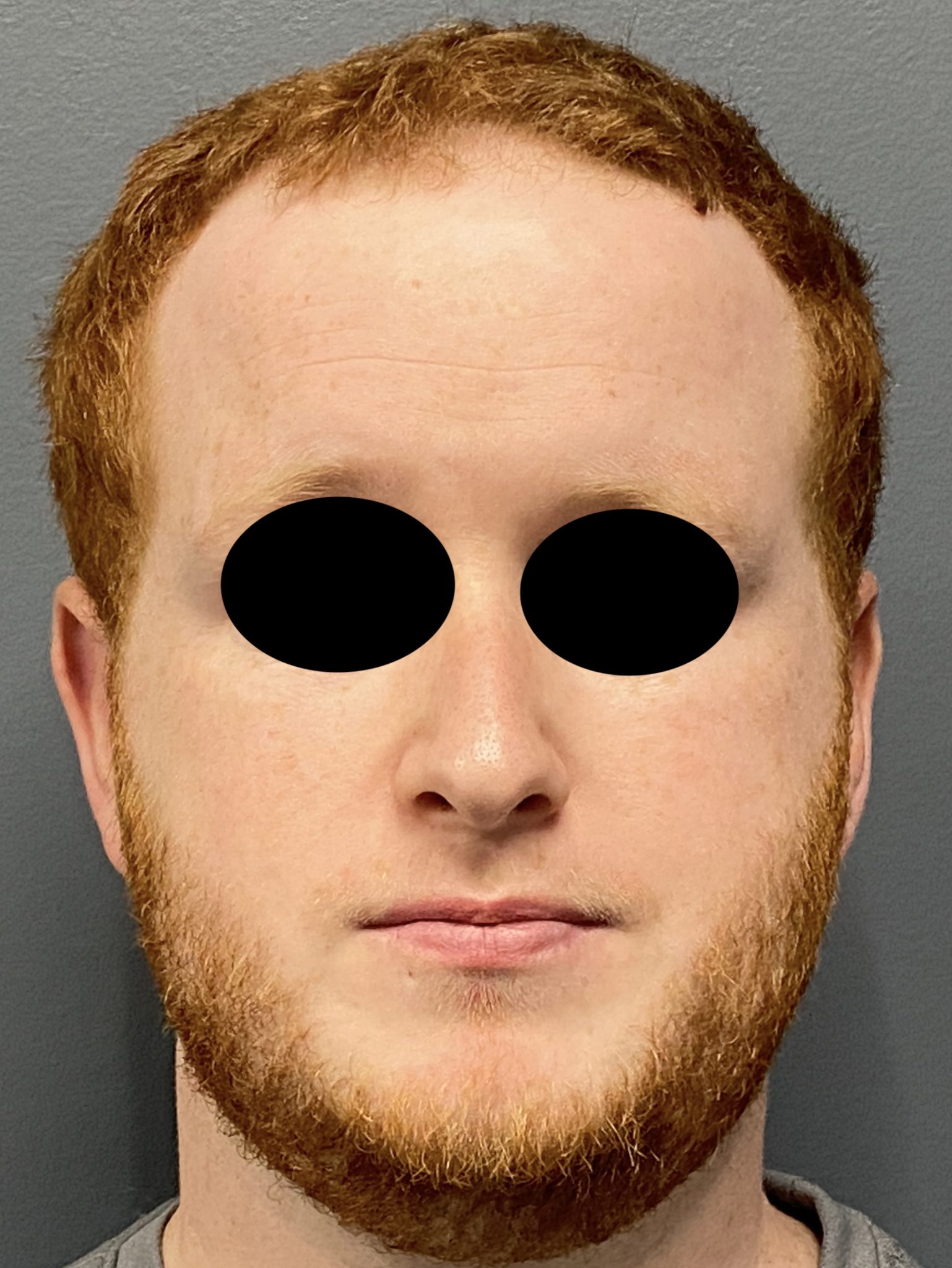 Plastic Surgery Case Study - Forehead and Temporal Skull Reductions for ...