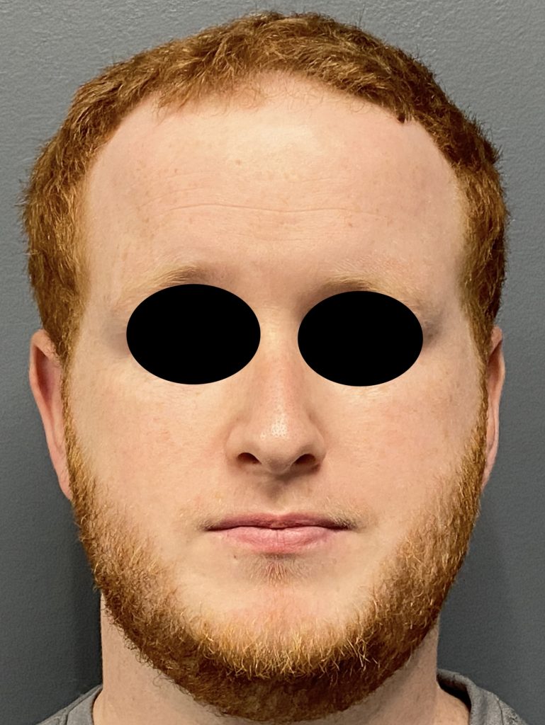 Plastic Surgery Case Study - Forehead and Temporal Skull Reductions for ...