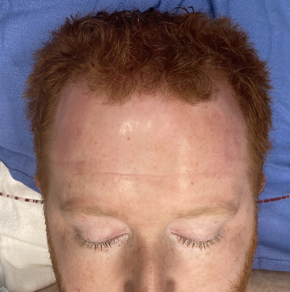 Plastic Surgery Case Study - Forehead and Temporal Skull Reductions for ...