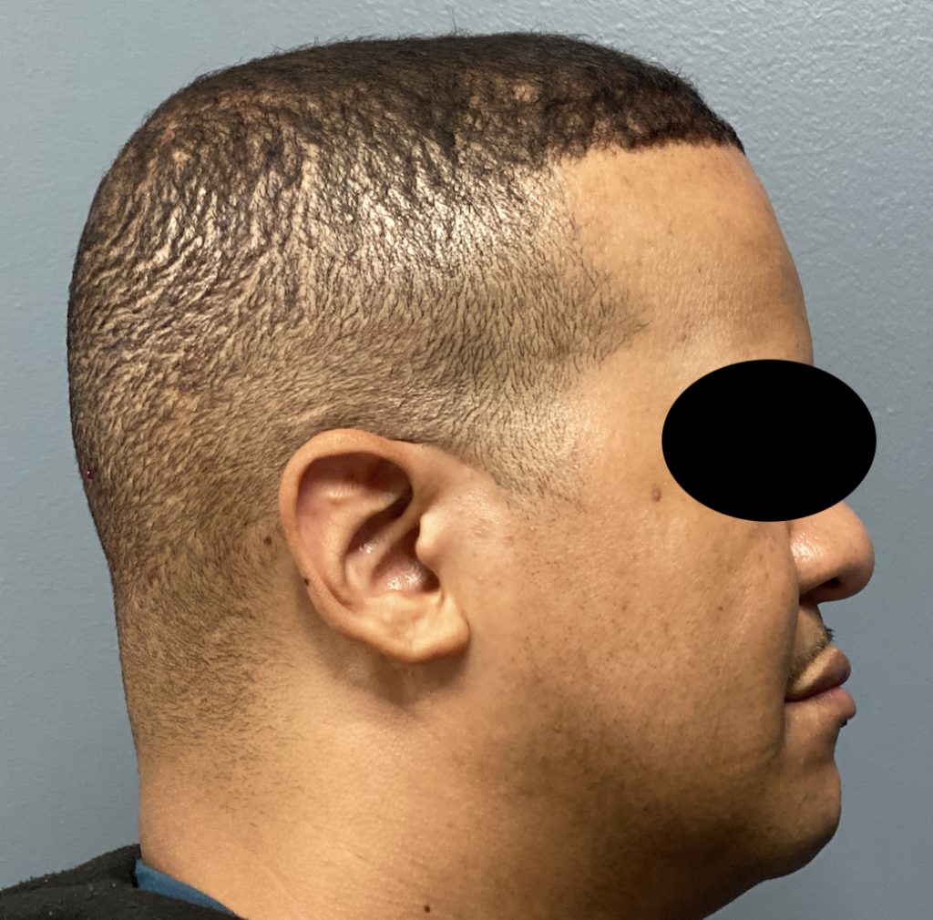 Plastic Surgery Case Study - Correction of the Forward Sloping Skull ...