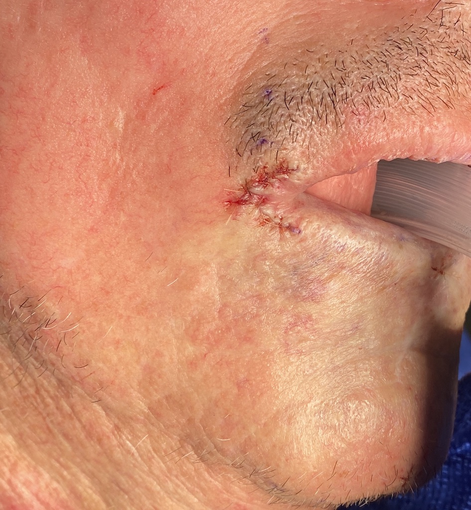 Technical Strategies - Orbicularis Wedge Muscle Removal in Mouth ...