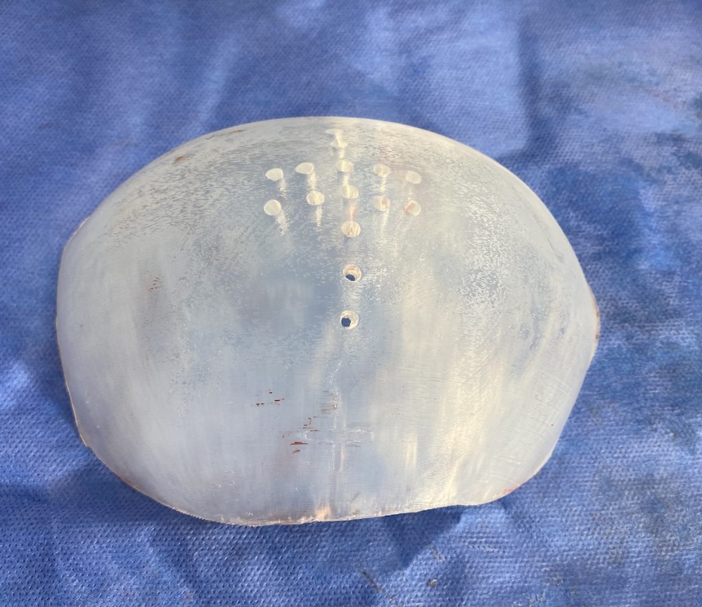 Plastic Surgery Case Study - Correction of the Forward Sloping Skull ...