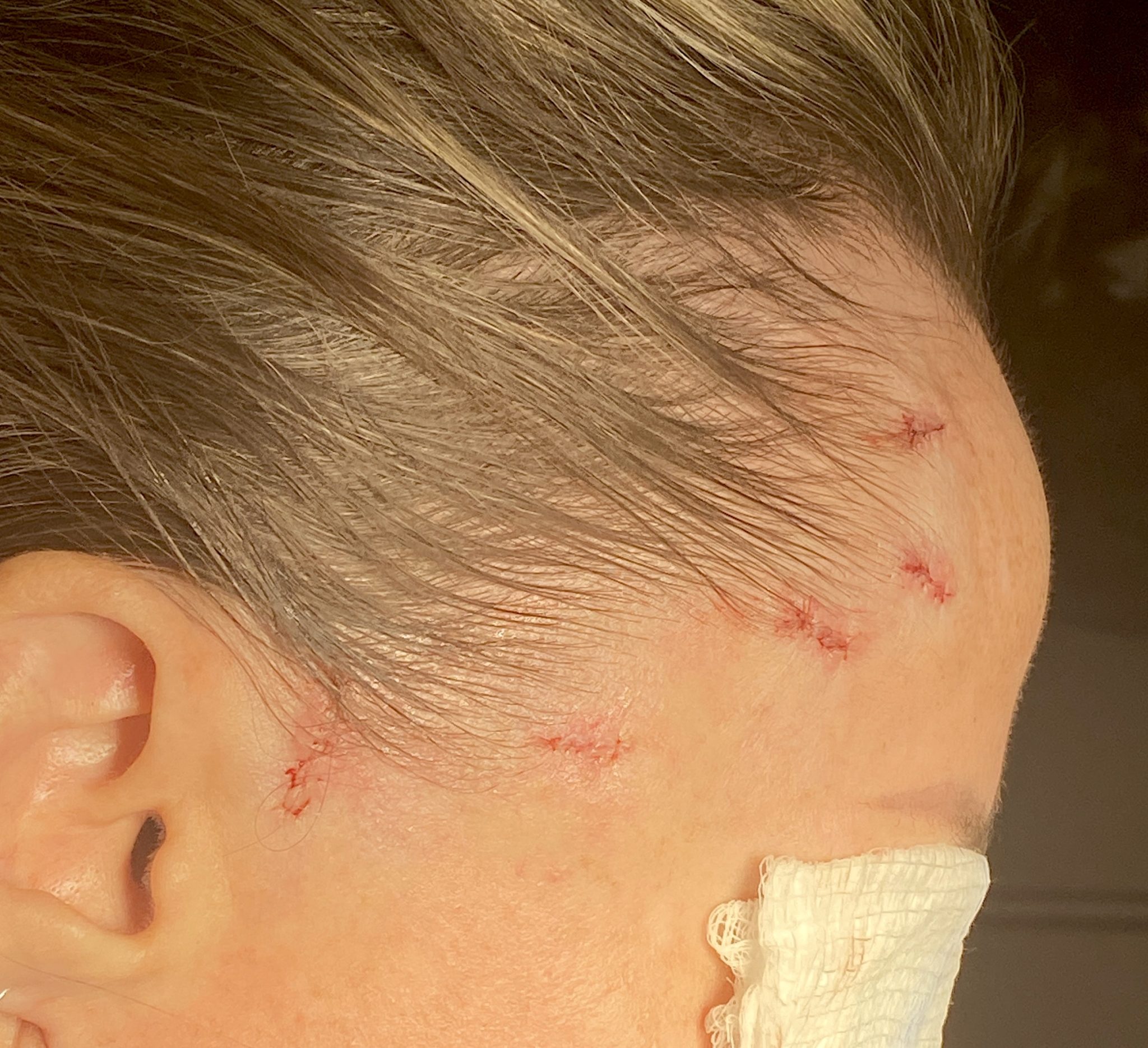 Plastic Surgery Case Study - Female Multi-Level Dopper Guided Temporal ...