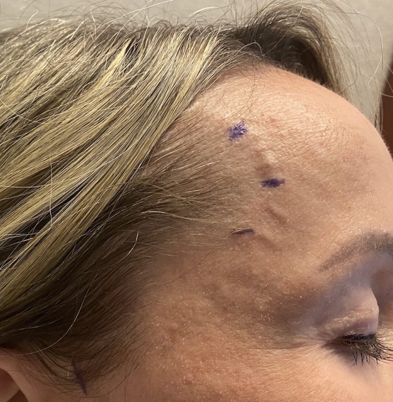 Plastic Surgery Case Study - Female Multi-Level Dopper Guided Temporal ...