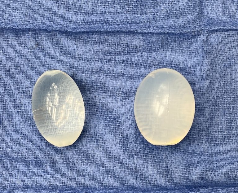 Plastic Surgery Case Study - Ultrasoft Solid Silicone Testicle Implant ...