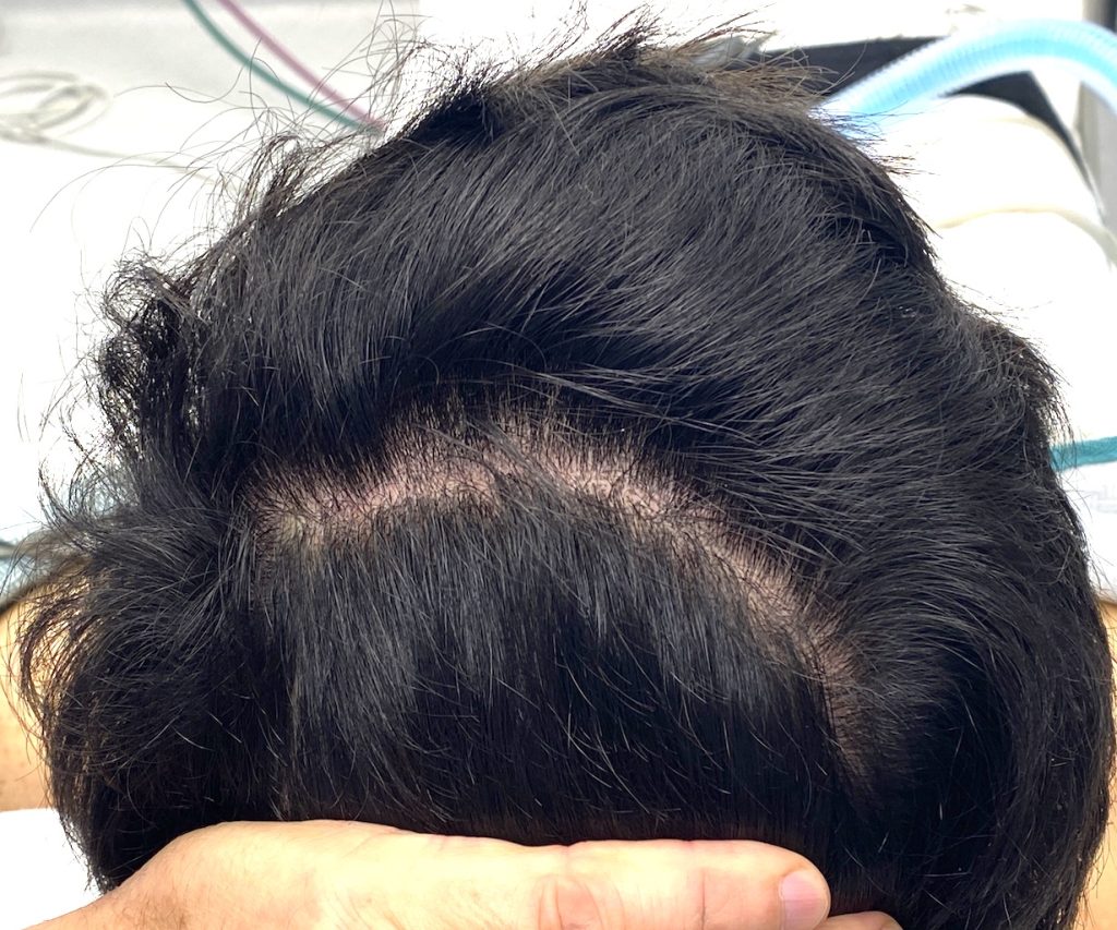 Plastic Surgery Case Study - The Male Extended Custom Forehead-Skull ...