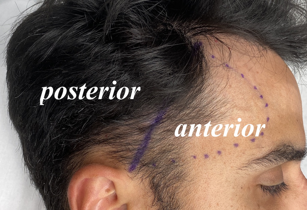anterior and posterior temporal reduction zones Dr Barry Eppley ...