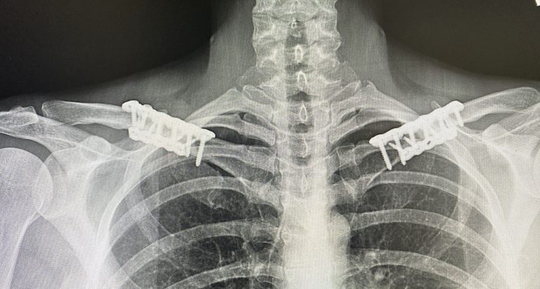 Plastic Surgery Case Study - Cis-Female Shoulder Narrowing Surgery with ...