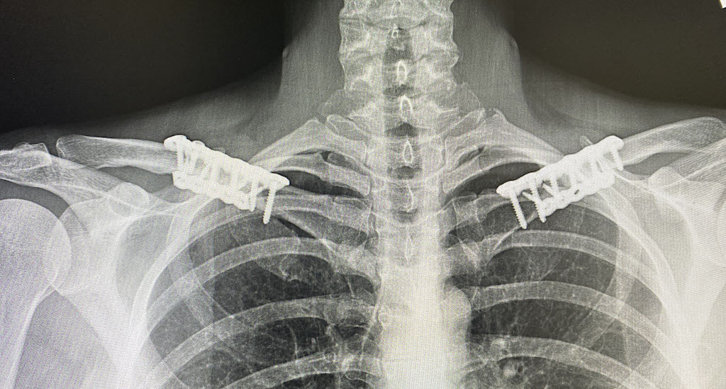 Plastic Surgery Case Study - Cis-Female Shoulder Narrowing Surgery with ...