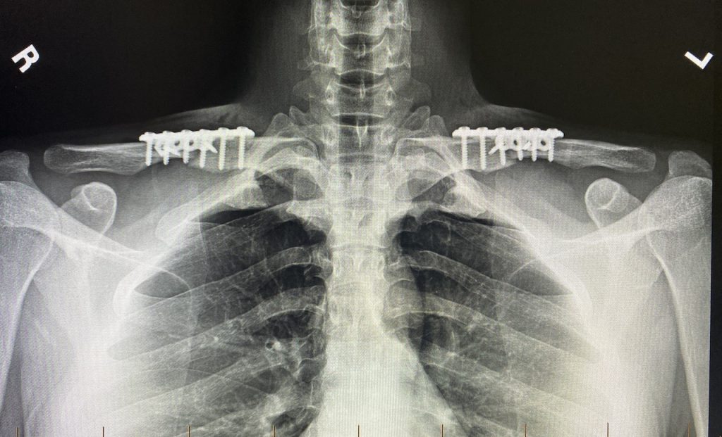 Plastic Surgery Case Study - Cross-Sectional Bone Thickness Differences ...