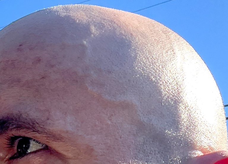 left prominent temporal artery Dr Barry Eppley - Explore Plastic Surgery