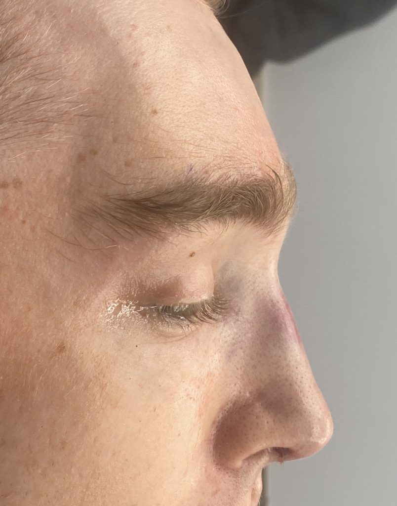 Plastic Surgery Case Study - Secondary Male Brow Bone Reduction by Bone ...