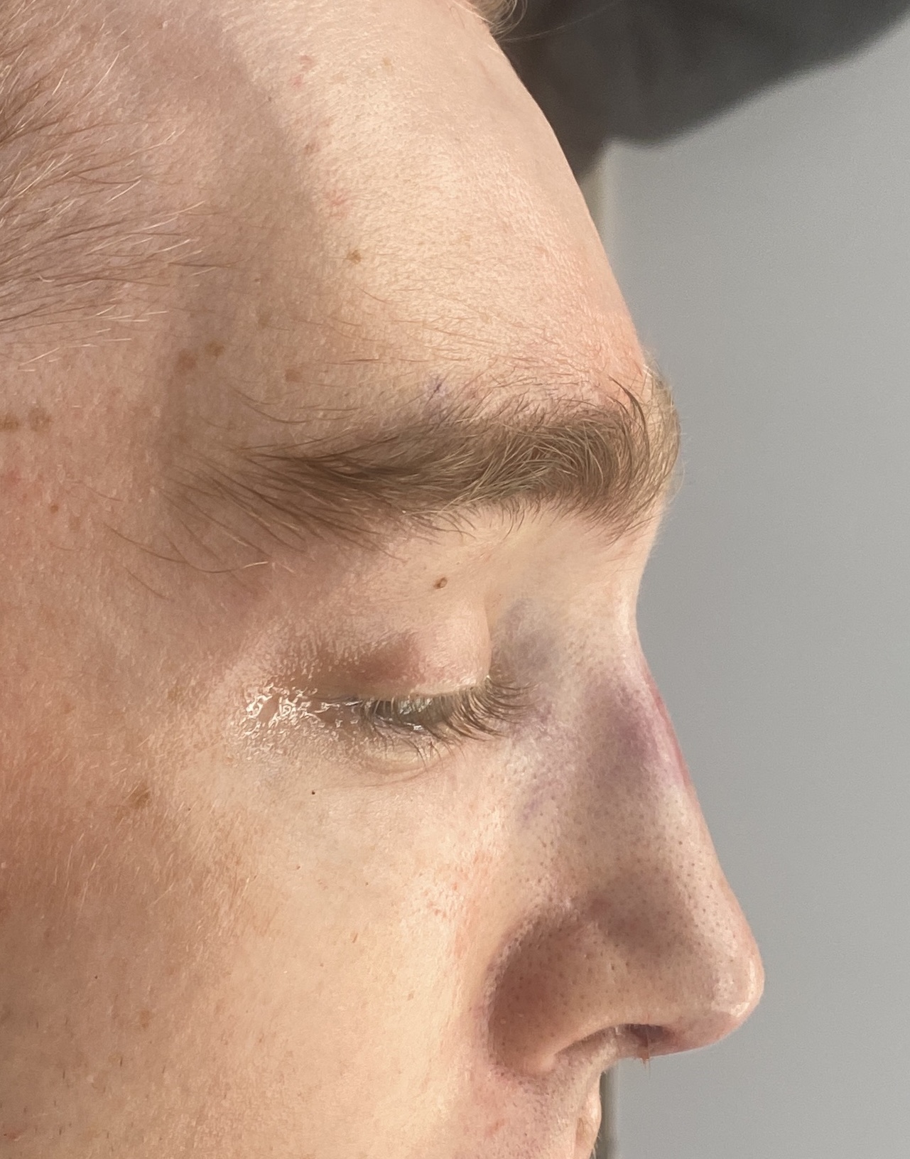 Plastic Surgery Case Study - Secondary Male Brow Bone Reduction by Bone ...