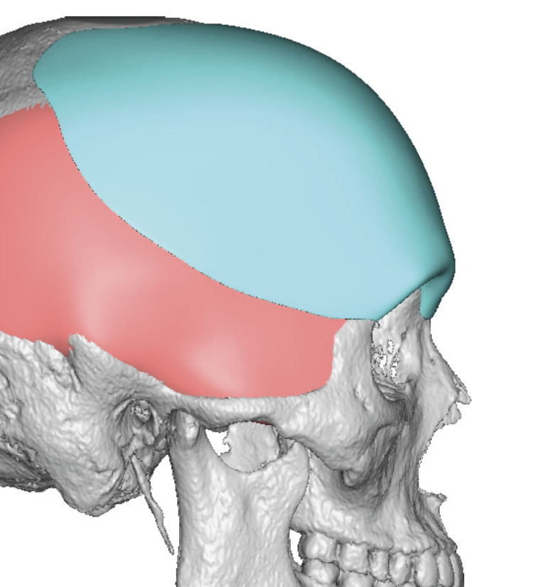 Plastic Surgery Case Study - Male Custom Forehead Brow Bone Implant ...