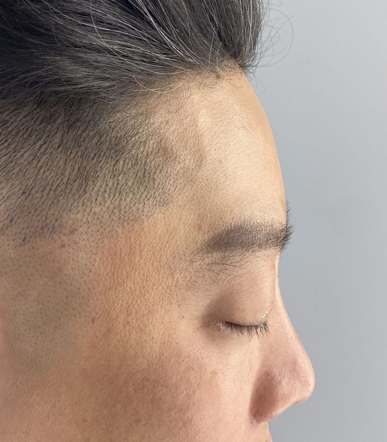 Plastic Surgery Case Study - Male Custom Forehead Brow Bone Implant ...