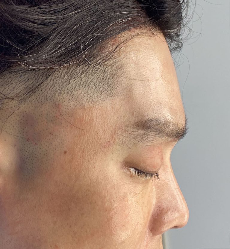 Plastic Surgery Case Study - Male Custom Forehead Brow Bone Implant ...