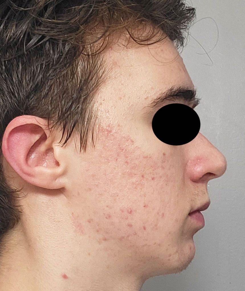 Plastic Surgery Case Study - Upper Face Masculinization with Custom ...