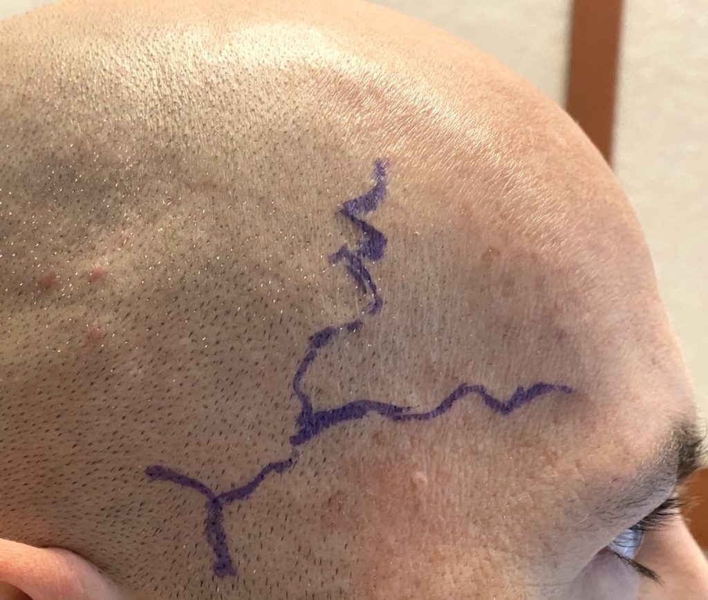 Plastic Surgery Case Study - Multi-Level Ligations of Type 1 Prominent ...