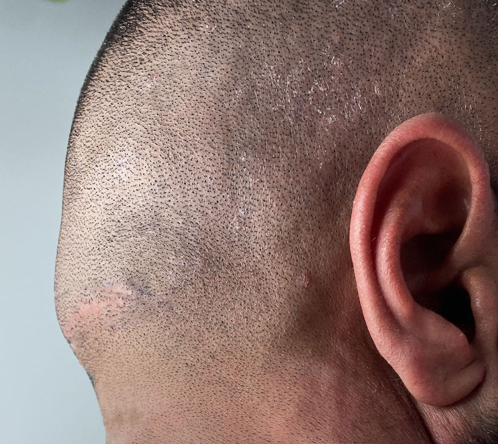 Plastic Surgery Case Study - Secondary Occipital Scalp Roll Excision ...