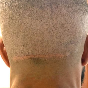 scalp reconstruction Archives - Explore Plastic Surgery