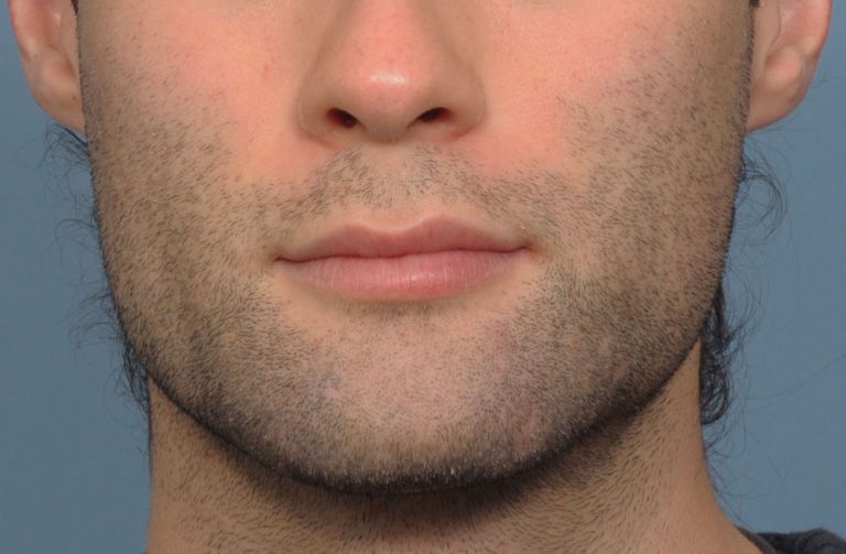 Plastic Surgery Case Study - Vertical Bony Chin Lengthening for ...