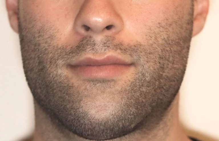 Plastic Surgery Case Study - Vertical Bony Chin Lengthening for ...