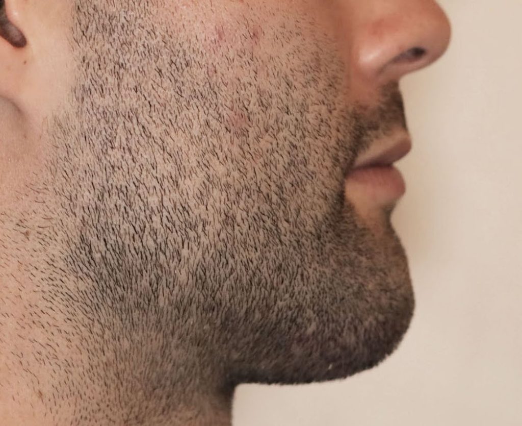 Plastic Surgery Case Study - Vertical Bony Chin Lengthening for ...