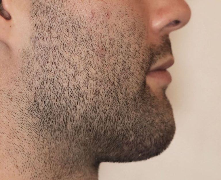 Plastic Surgery Case Study - Vertical Bony Chin Lengthening for ...