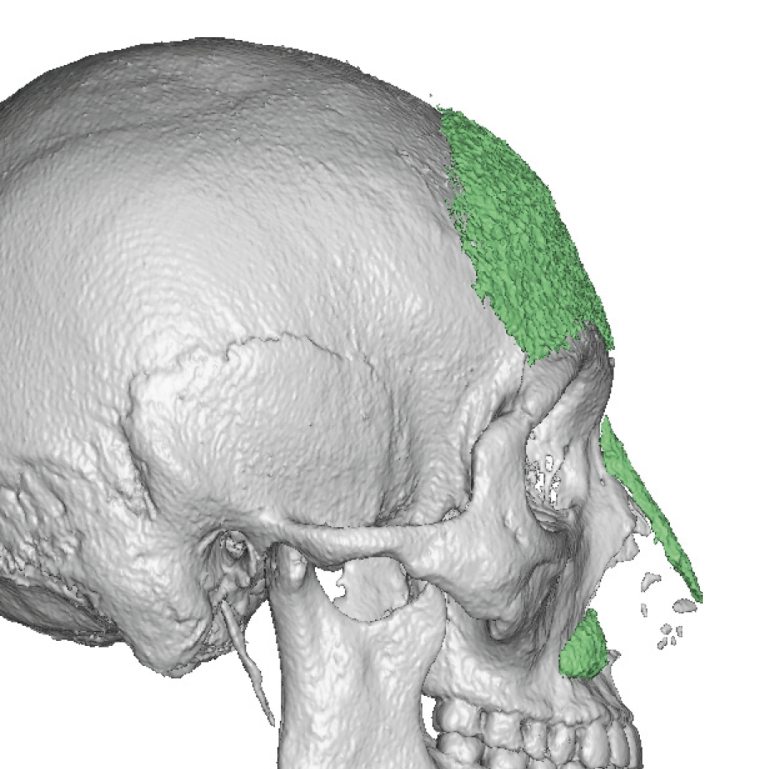 Plastic Surgery Case Study - Male Custom Forehead Brow Bone Implant ...