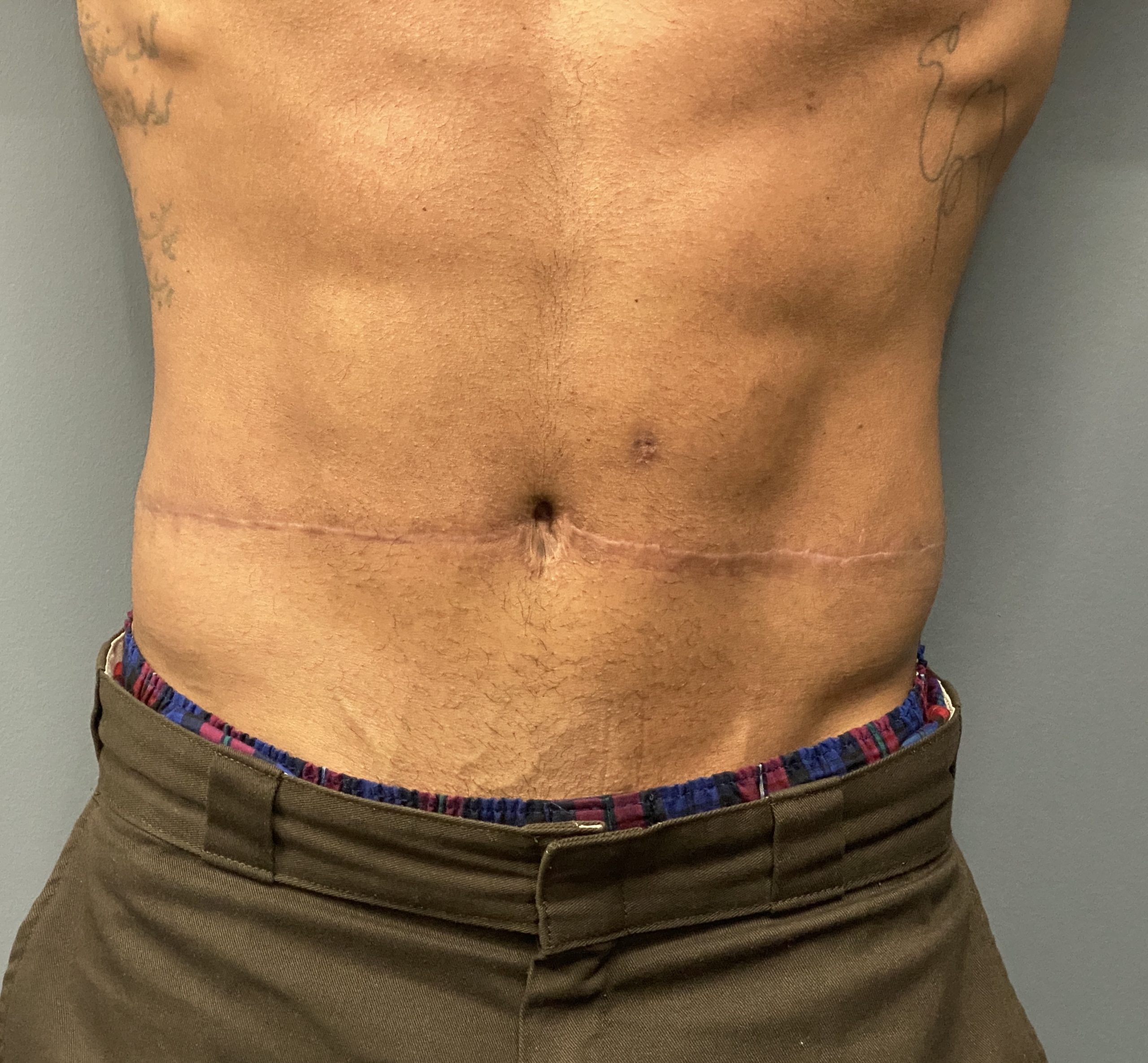 malew mid-abdominal tuck scar result arms raised Dr Barry EppleyJPG ...