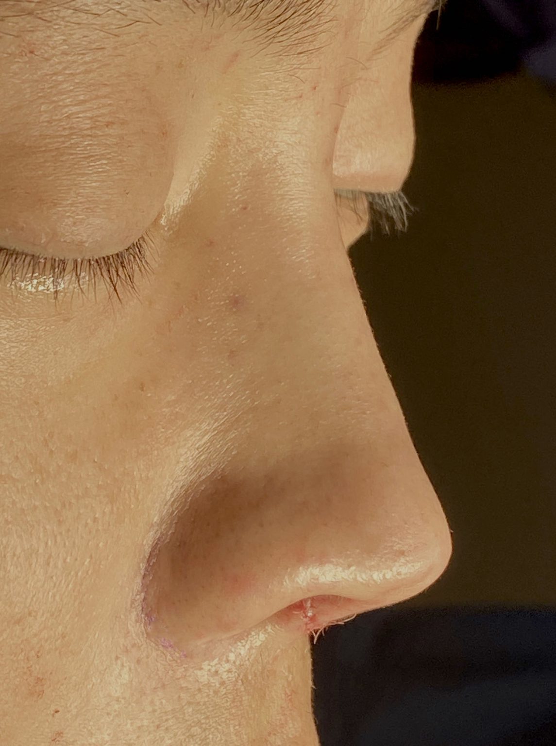 Plastic Surgery Case Study - 2nd Stage Asian Rhinoplasty with Larger ...