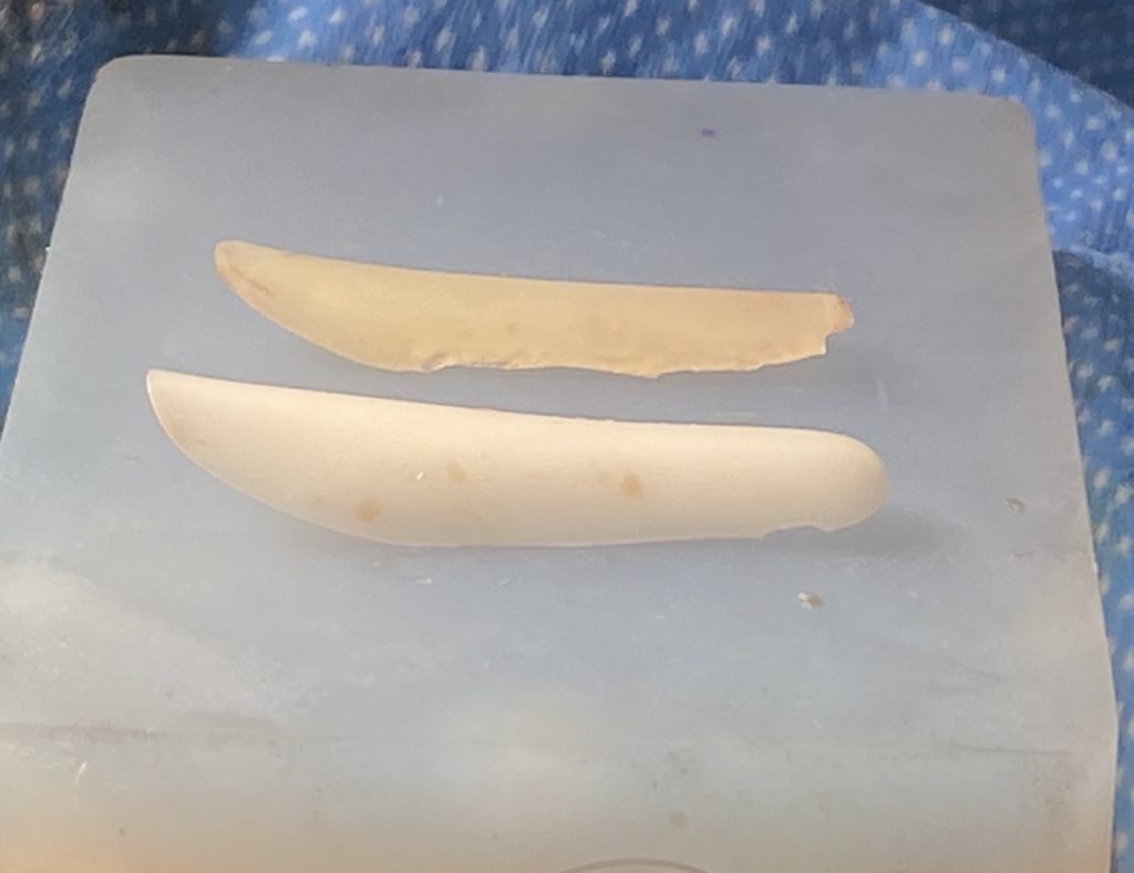 Plastic Surgery Case Study - 2nd Stage Asian Rhinoplasty with Larger ...