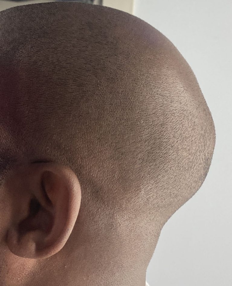 Plastic Surgery Case Study - Male Occipital Bun Skull Reduction ...