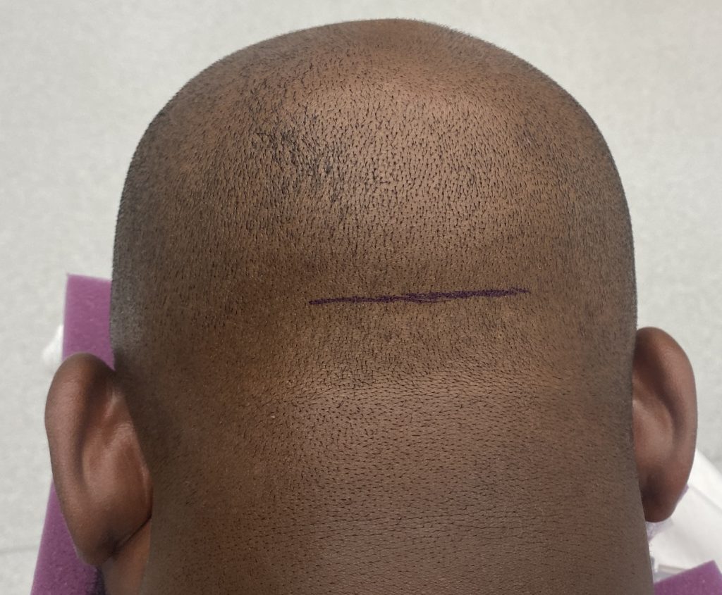 Plastic Surgery Case Study - Male Occipital Bun Skull Reduction ...