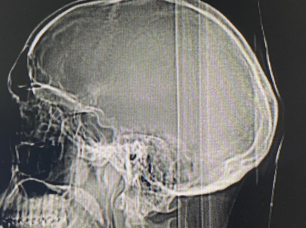 Plastic Surgery Case Study - Male Occipital Bun Skull Reduction ...