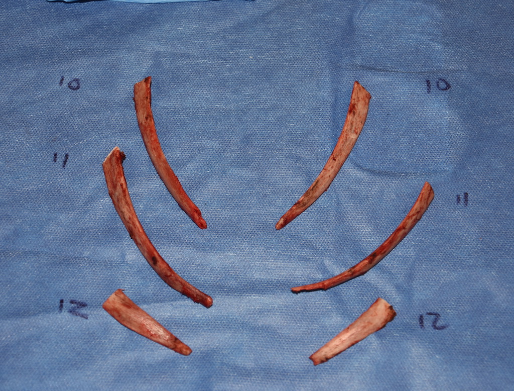 3D CT Scan Evaluation of the Impact of the Lower Ribcage on the ...