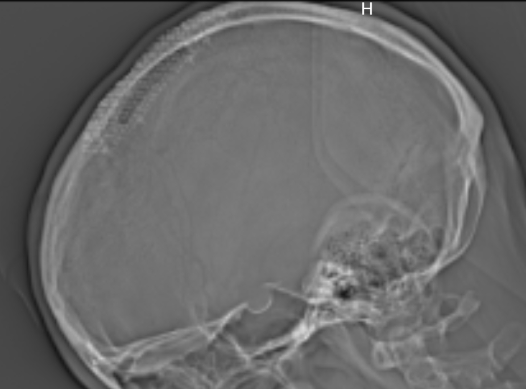 skull defect mesh plate lateral skull x ray Dr Barry Eppley - Explore ...