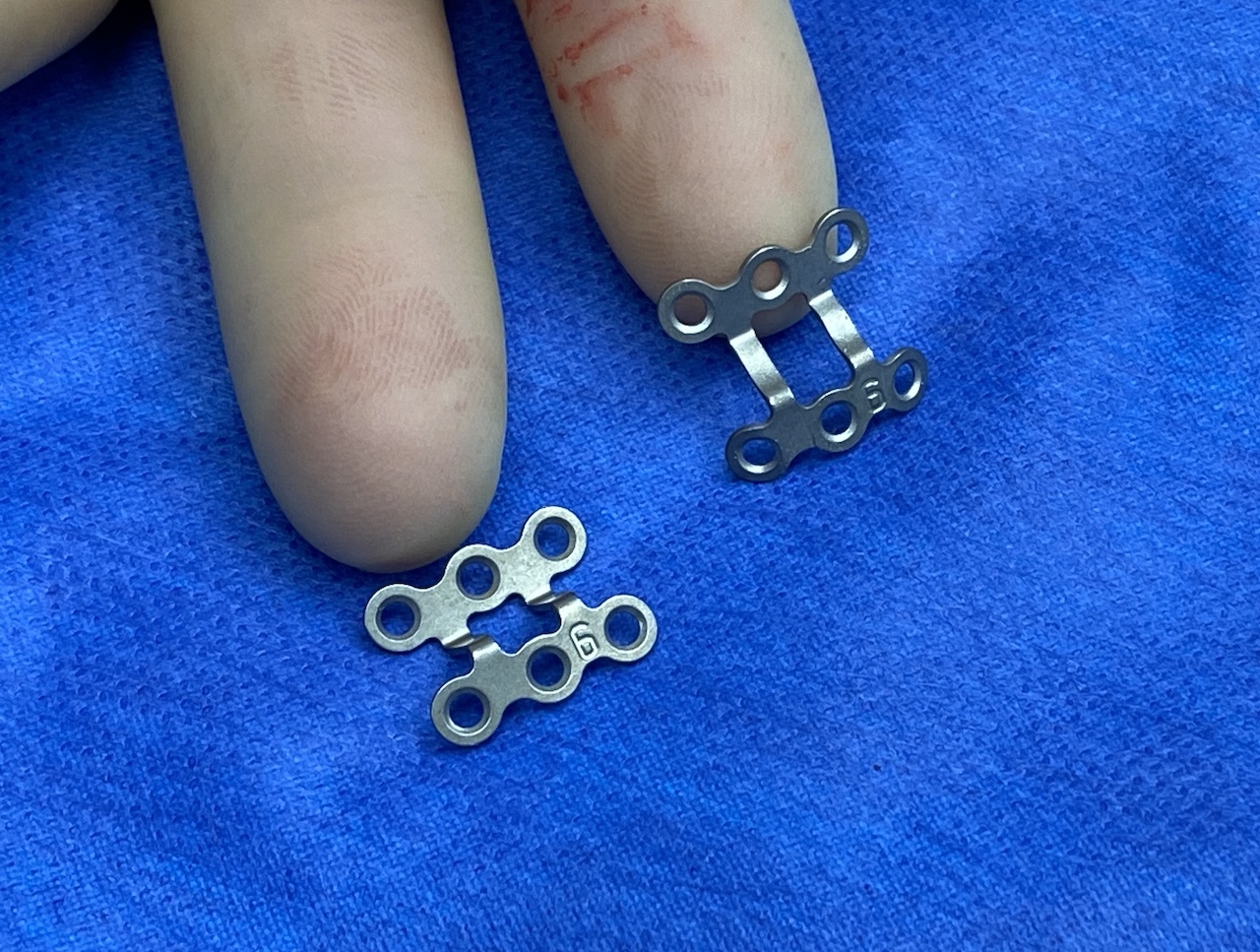 sliding geniopalsty plate modification Dr Barry Eppley - Explore ...