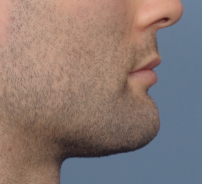 Plastic Surgery Case Study - Vertical Bony Chin Lengthening for ...