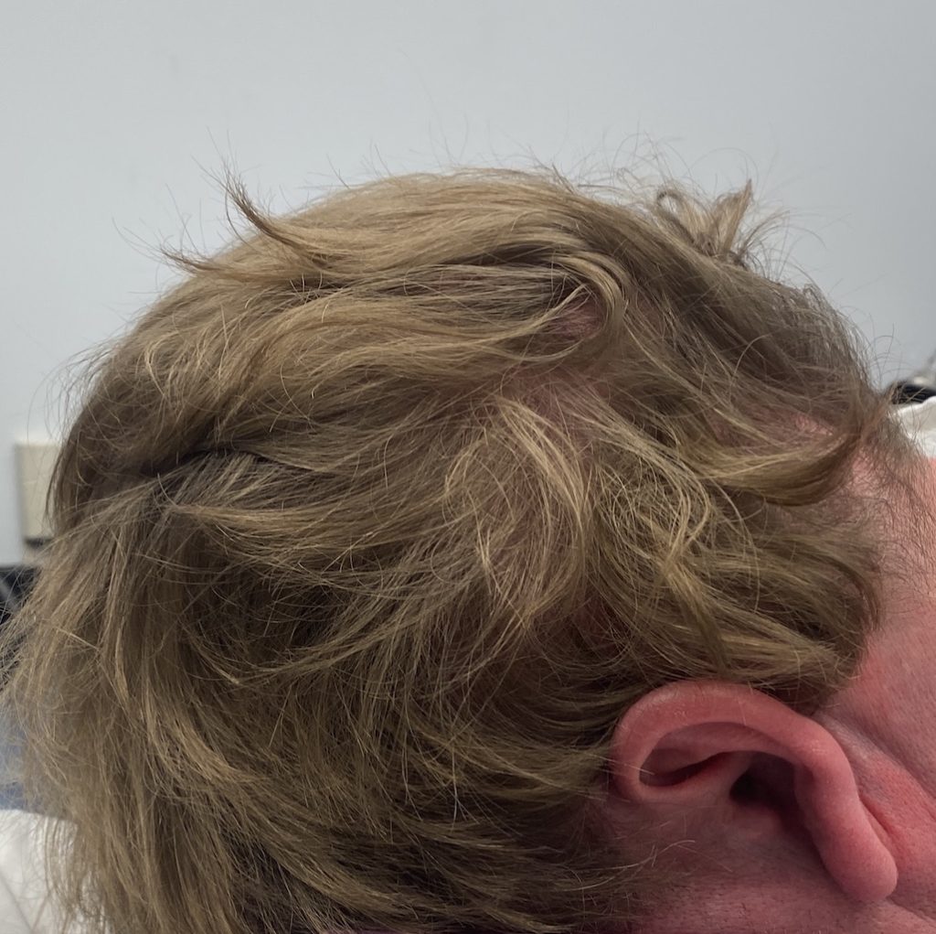 Plastic Surgery Case Study - Two Stage Male Back of Head Skull Implant ...