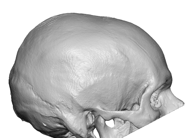corornal dip skull deformity 3D CT scan side view Dr Barry Eppley ...