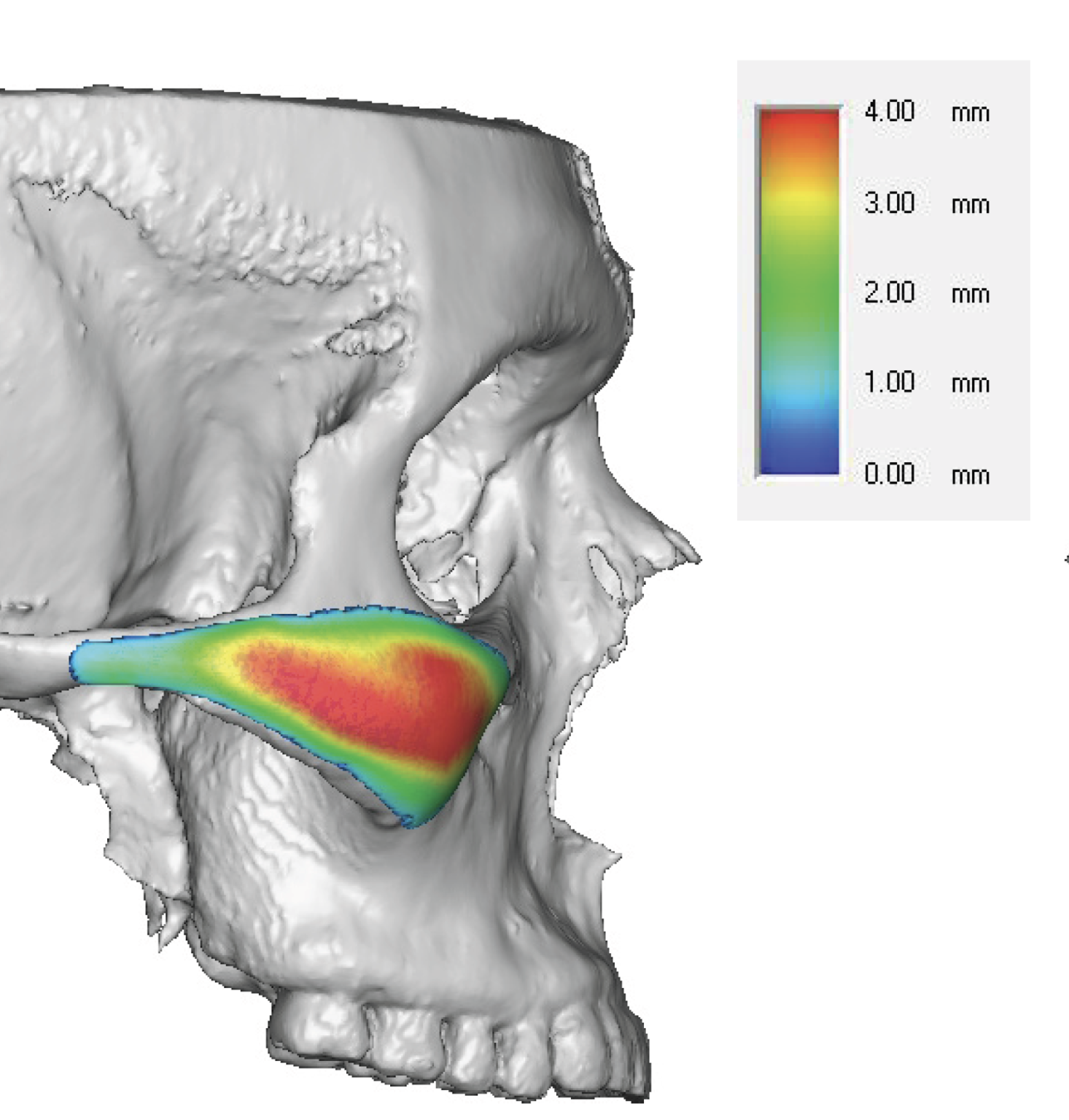Understanding the Anatomic Basis of the High Cheekbone Implant ...