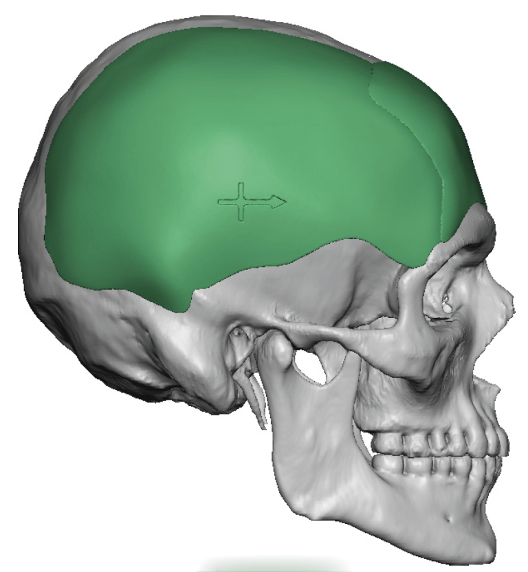 Plastic Surgery Case Study - Custom Mastoid Skull Implants after Large ...