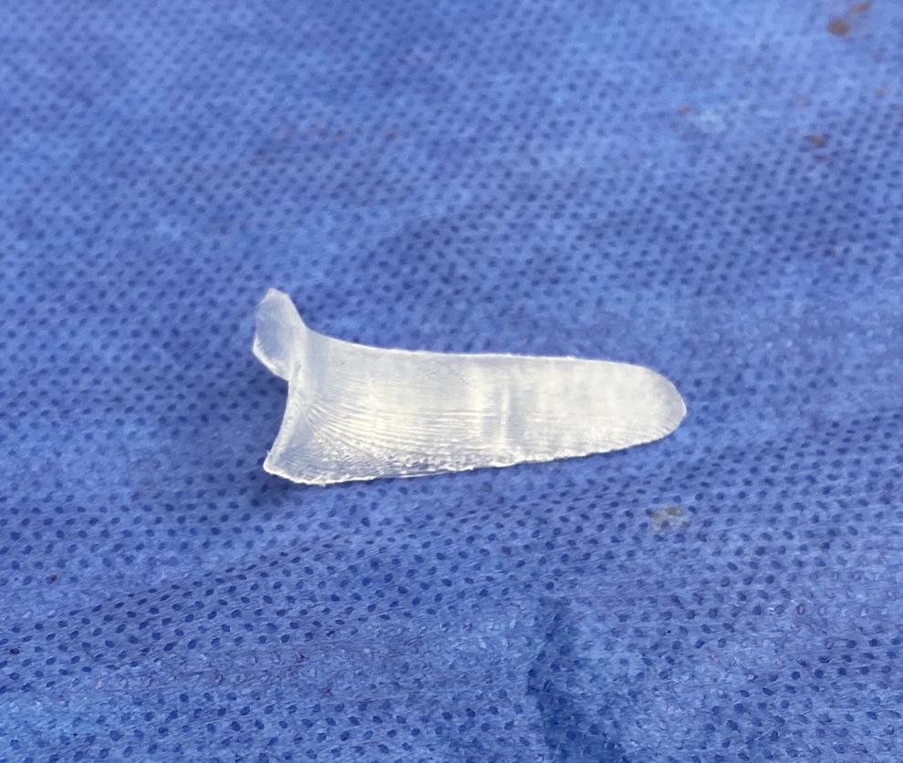 Plastic Surgery Case Study - Custom Nasal Implant for Improved ...